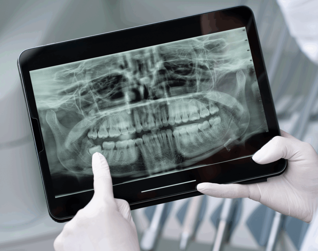 What Are the Signs Your Wisdom Teeth Need to Come Out? - Mooresville ...